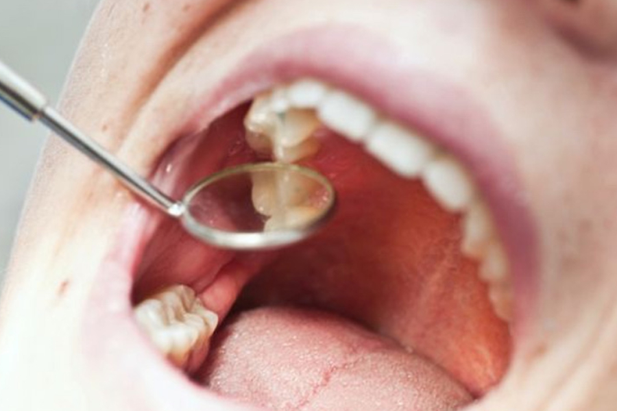 5 Natural Remedies For Toothache