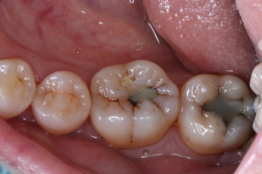 Dental Cavities: Risks & Complications